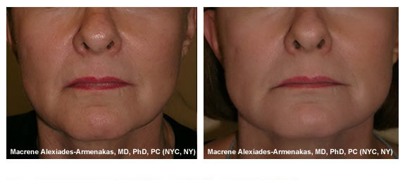 Skin Resurfacing Sacramento | Skin Rejuvenation Rocklin, CA