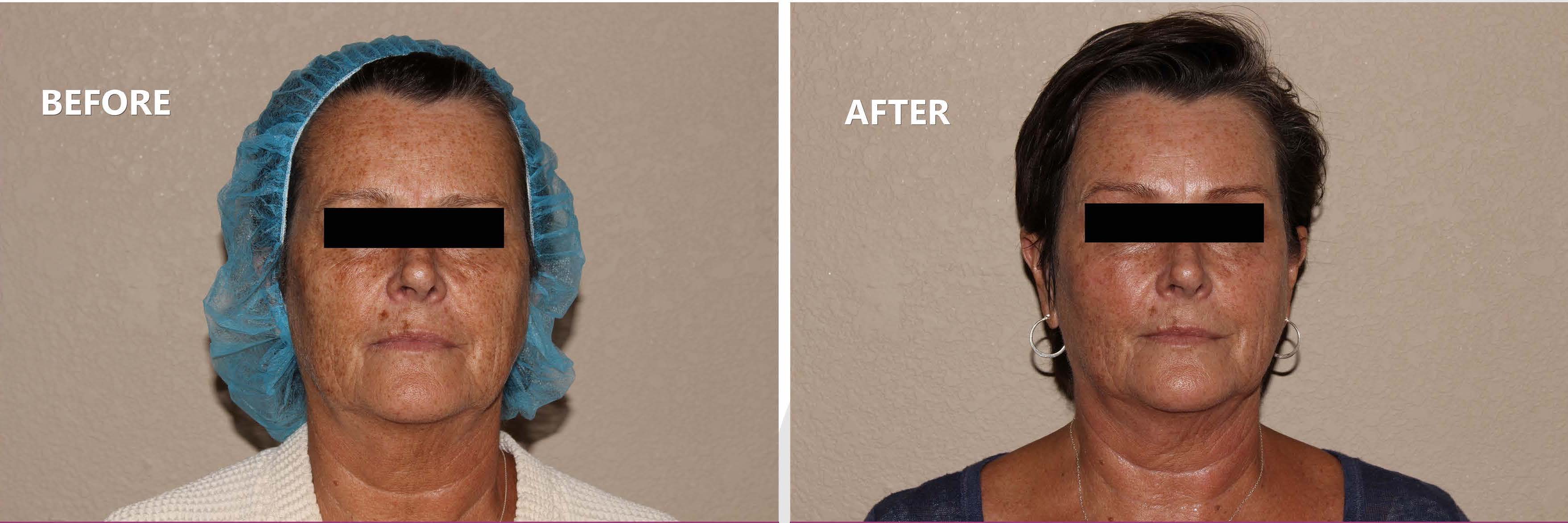 The Time Machine Treatment Sacramento | Physicians Laser