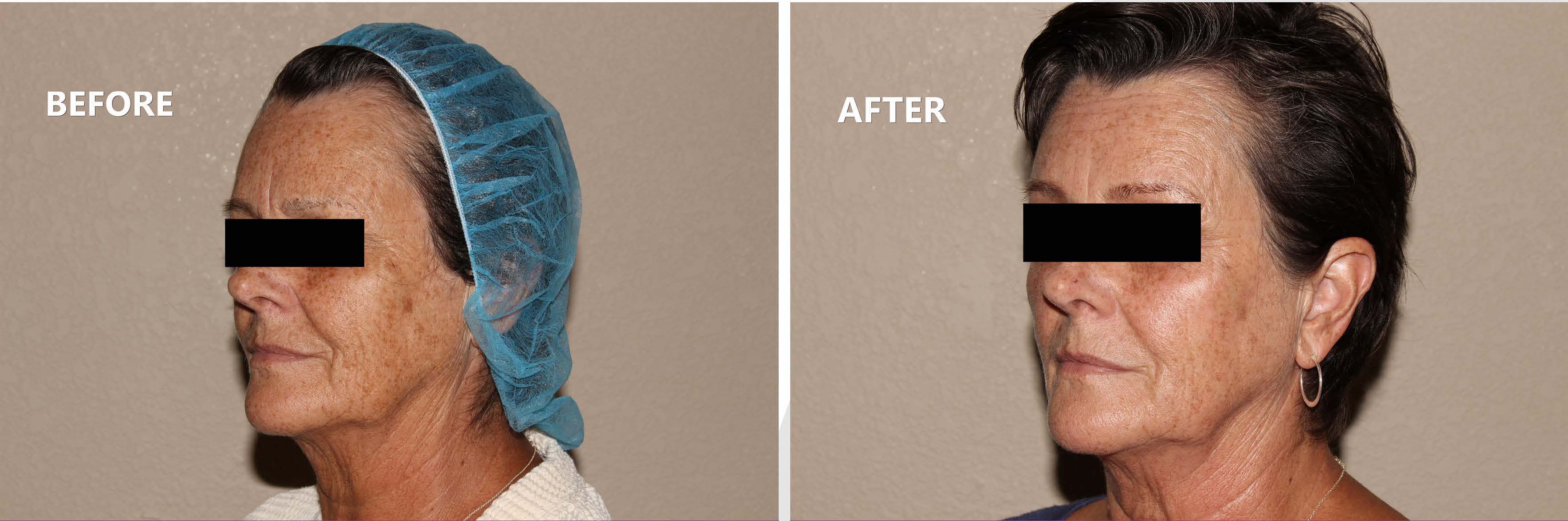 The Time Machine Treatment Sacramento | Physicians Laser