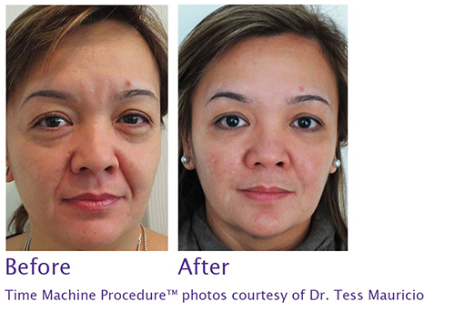 The Time Machine Treatment Sacramento | Physicians Laser